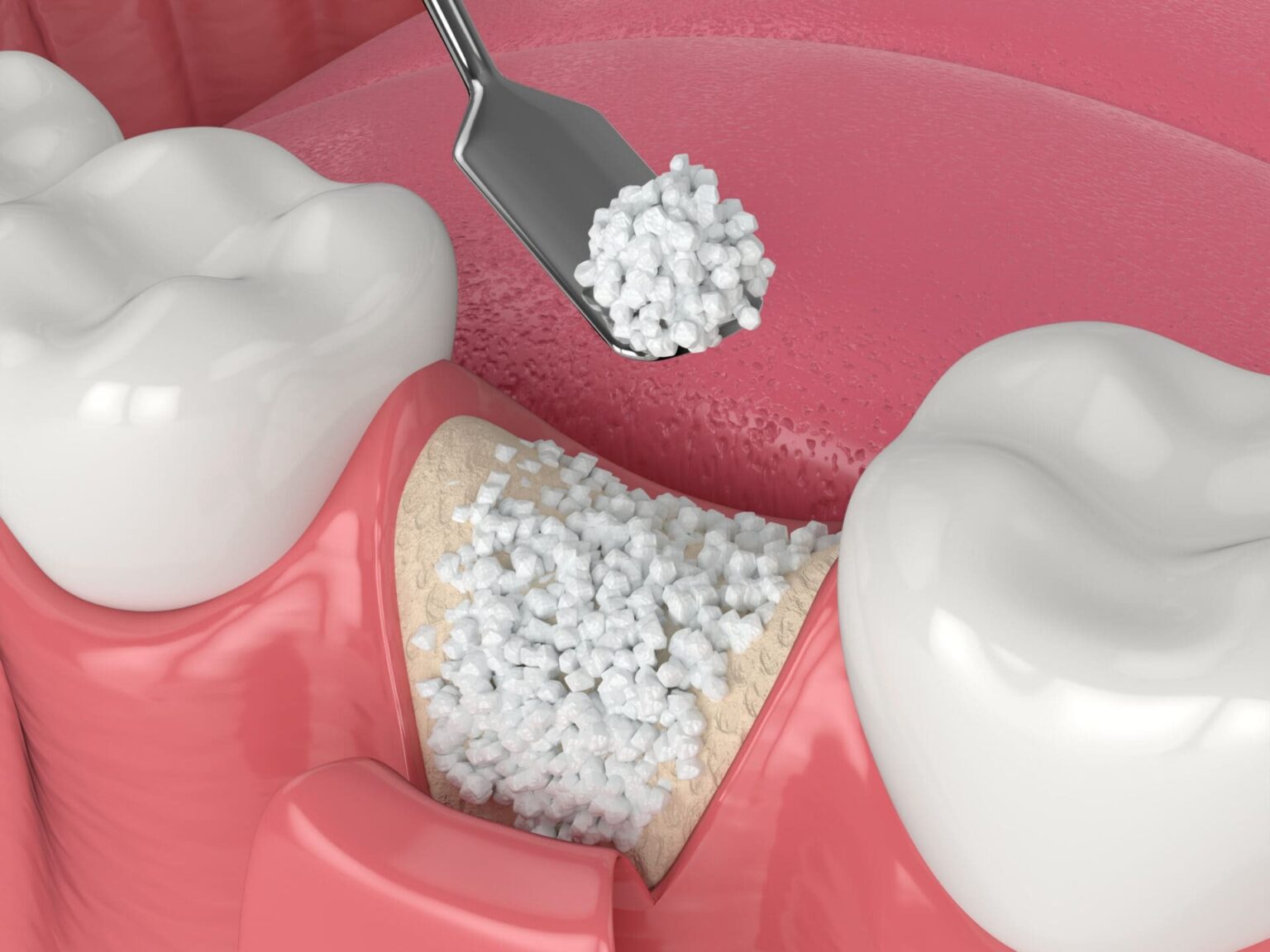 What Happens to Your Jawbone After Tooth Loss and How to Stop It - KiwiBox