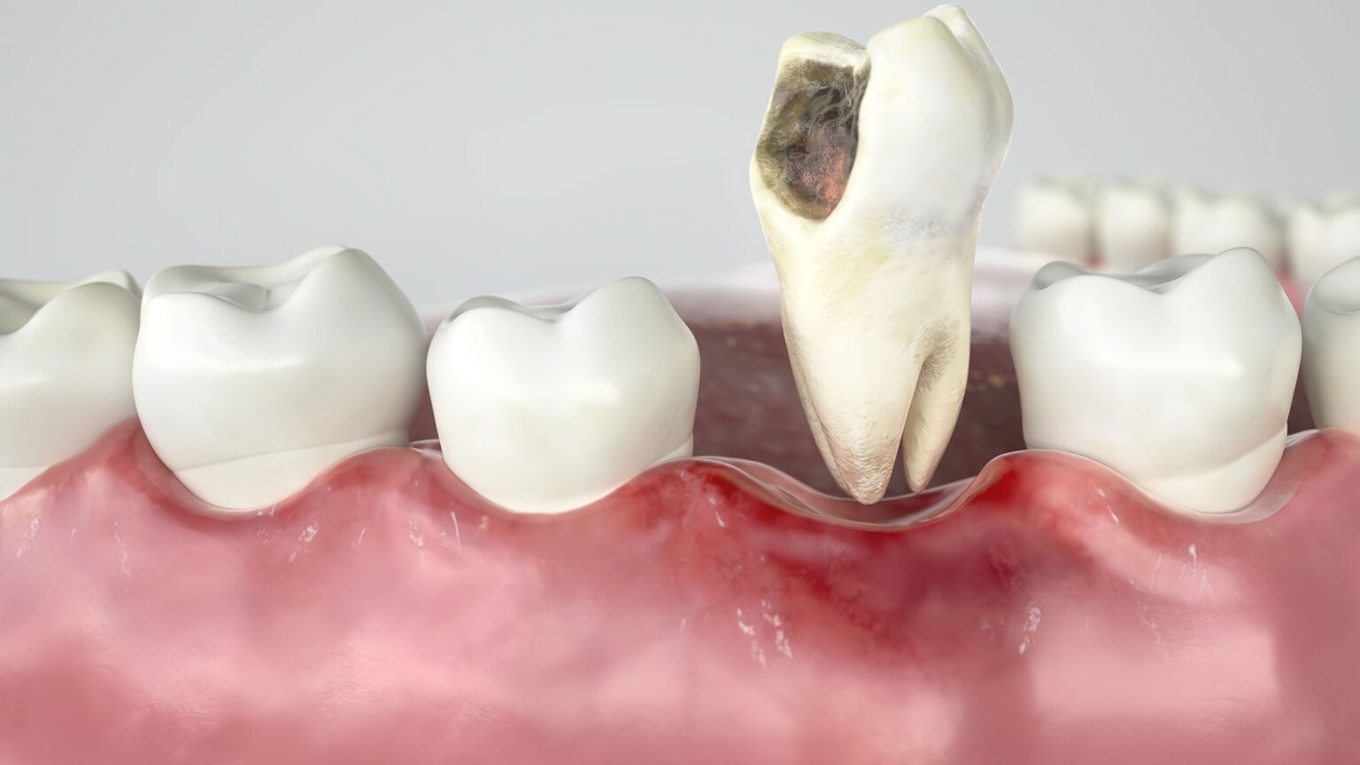 What Happens to Your Jawbone After Tooth Loss and How to Stop It - KiwiBox
