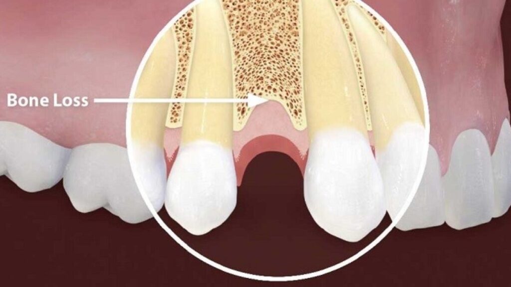 What Happens to Your Jawbone After Tooth Loss and How to Stop It - KiwiBox